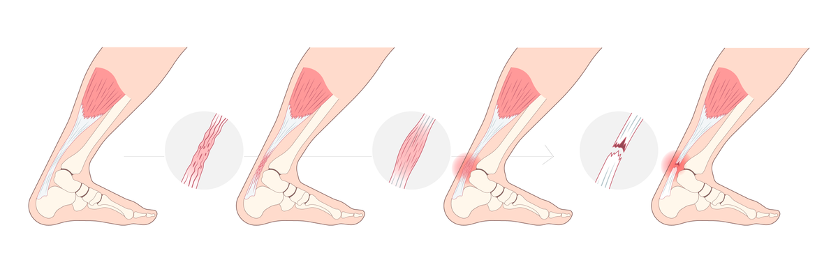 Achilles Tendon Surgical Repair Journey – Cottonwood Limited